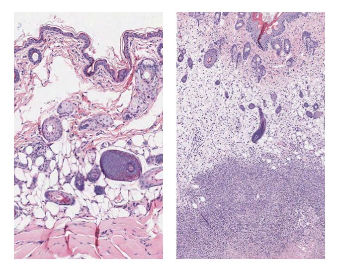 Flesh-Eating Bacteria Carry Genes for Getting Under Your Skin, and Thriving